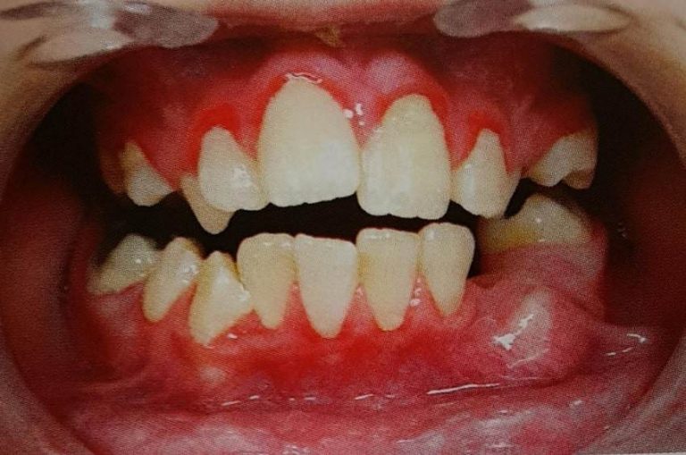 malocclusion Archives - Bodhi Health Education